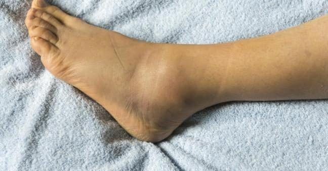 Edema: cos'è, i sintomi e le cause | Ohga!