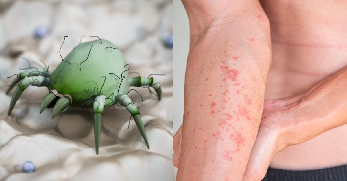 Acari nel letto: cosa sono e come eliminarli con rimedi naturali ...